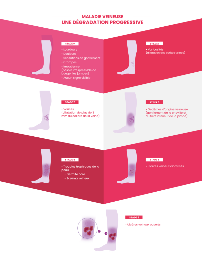 La maladie veineuse : le système circulatoire affecté - Servier